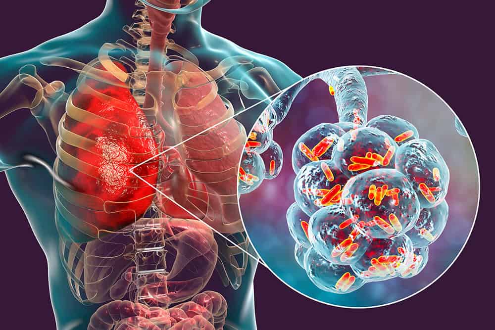 Cayman investigate confirmed Legionnaires’ disease case