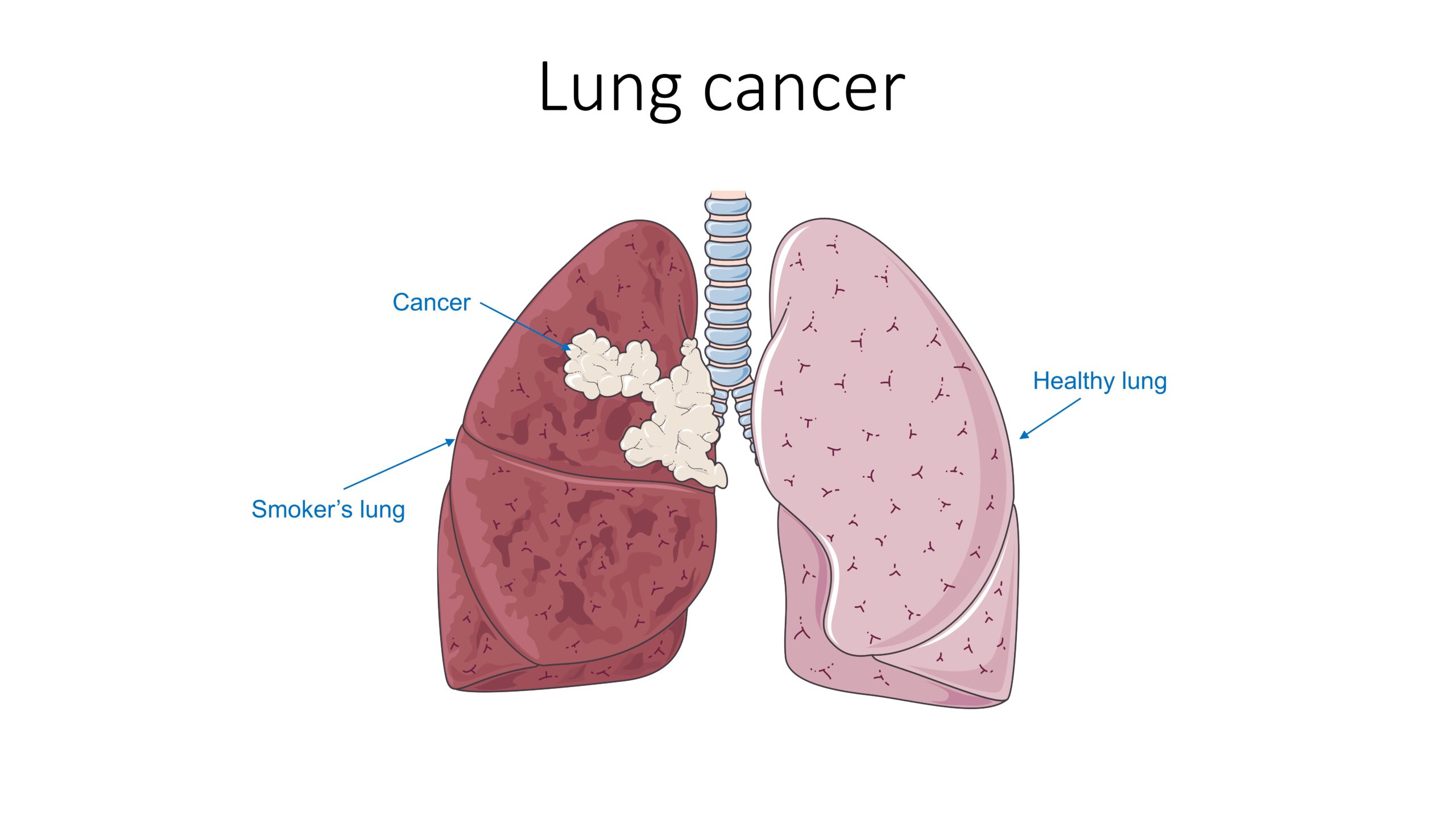 Lung_cancer_-_Healthy_lung_Smokers_lung_with_cancer_-_Smart-Servier ...